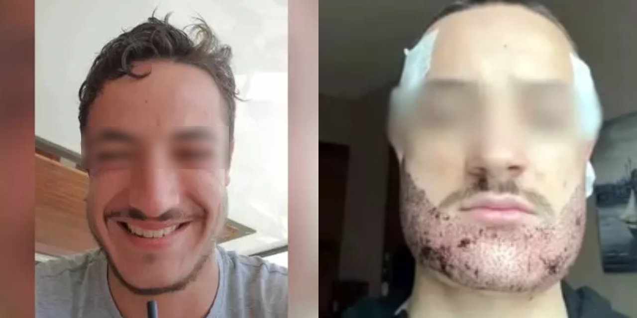 Sakal ektirmek için Fransa'dan Türkiye'ye gelen genç intihar etti ...